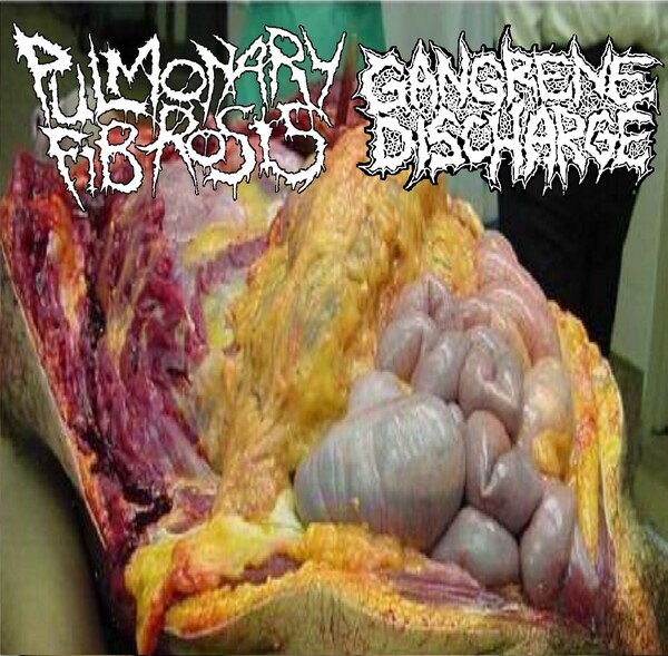 Pulmonary Fibrosis & Gangrene Discharge - Pulmonary Fibrosis / Gangrene ...