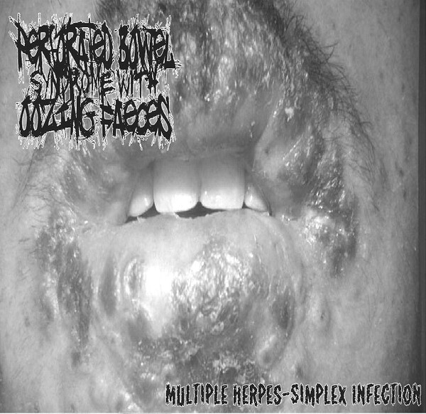 Perforated Bowel Syndrome With Oozing Faeces - Multiple Herpes-Simplex ...