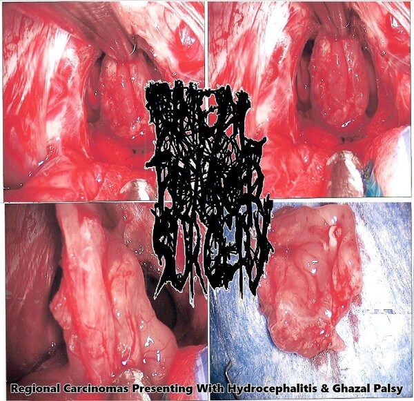 Pineal Tumor Surgery - Regional Carcinomas Presenting With ...